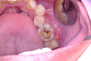 What Is a Tooth Filling? How It Strengthens Damaged Teeth